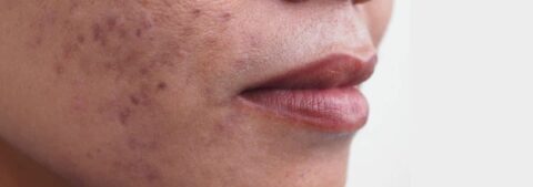 Post-Inflammatory Hyperpigmentation – All You Need to Know - Dr Swetha ...