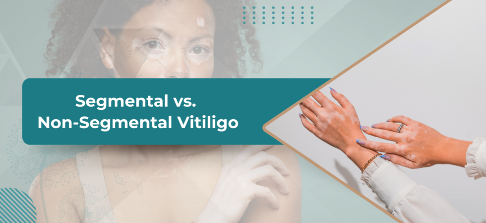 Segmental vs. Non-Segmental Vitiligo: Understanding the Key Differences