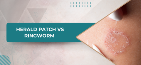 Herald Patch vs. Ringworm: A Comparative Guide